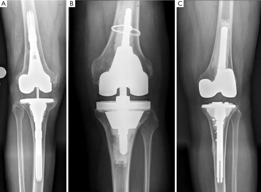 Robotic Knee Joint Replacement Surgery And Everything Related To It Robotic Knee Joint Replacement Surgery And Everything Related To It