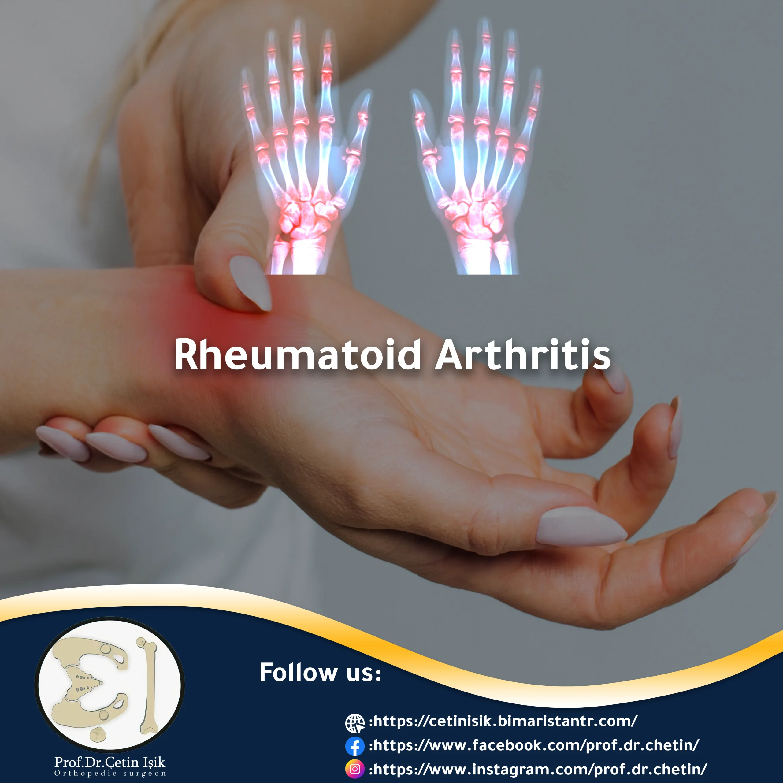 Everything related to the diagnosis and treatment of rheumatoid ...