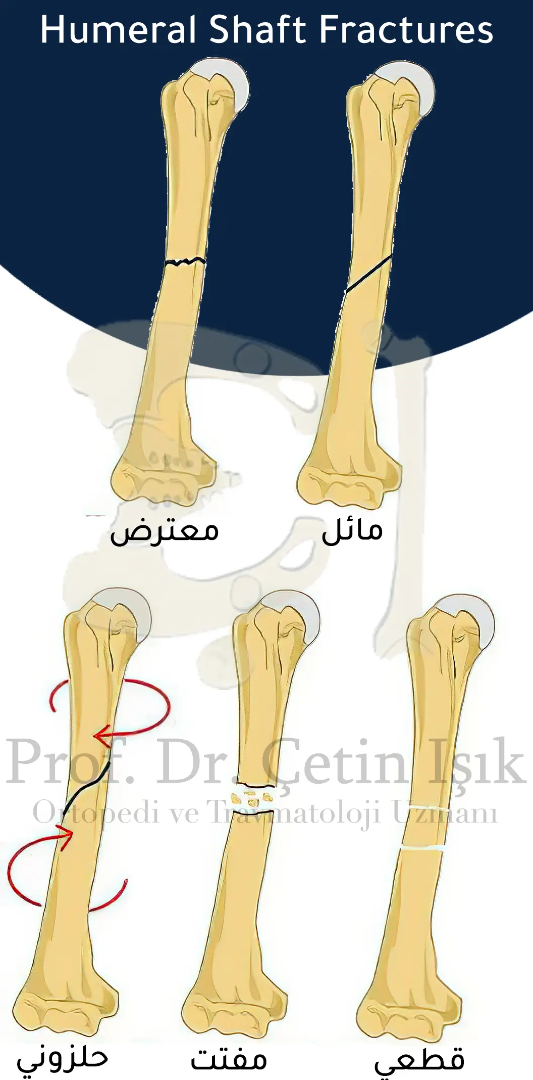كسر العضد؛ من التشخيص إلى العلاج د شتين اشيك